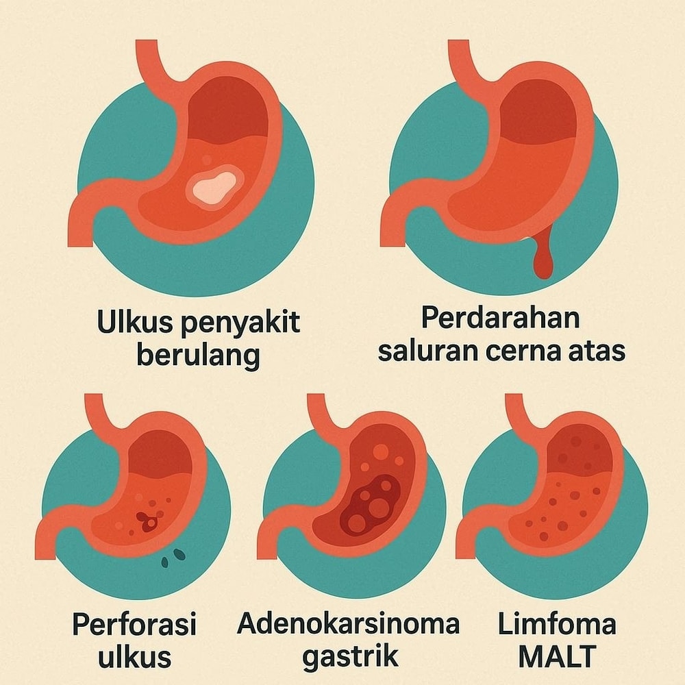 Helicobacter pylori: Definisi, Patogenesis, Diagnosis, dan Penatalaksanaan